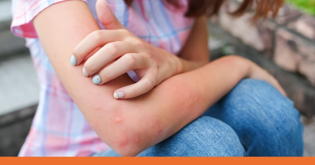 Why Consult an Urgent Care Doctor for Insect Bites - DOCS URGENT CARE
