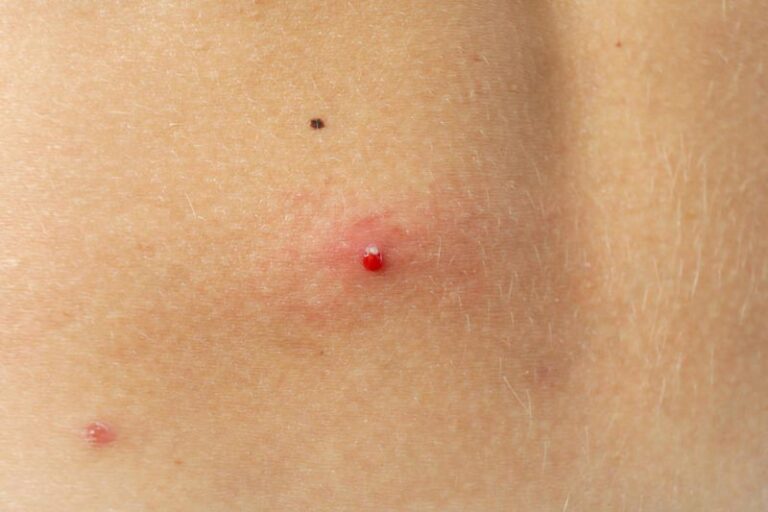 When to Visit an Urgent Care in Branford, CT, for a Bug Bite