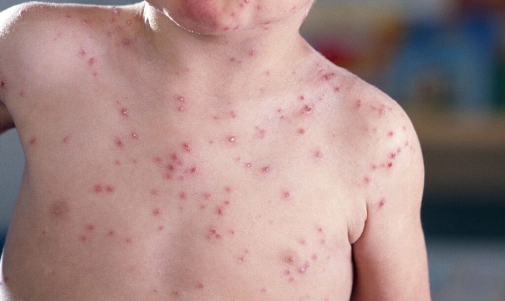 Chickenpox: Symptoms and When to Seek Urgent Care in Fairfield, CT