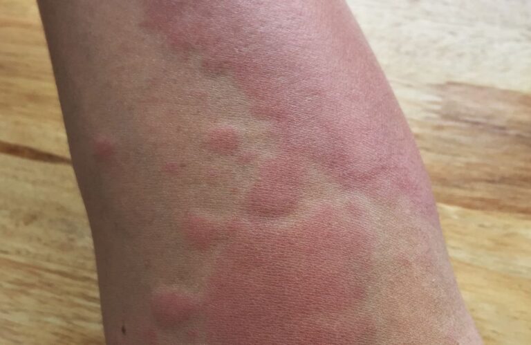 Treating Hives: Insights from a Primary Care Doctor in Fairfield, CT