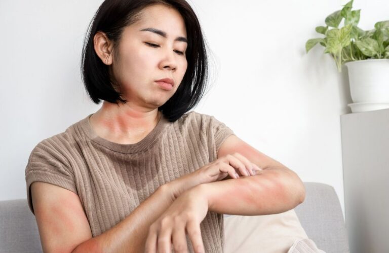 12 Natural Remedies for Hives: When to Seek Help from Urgent Care in ...