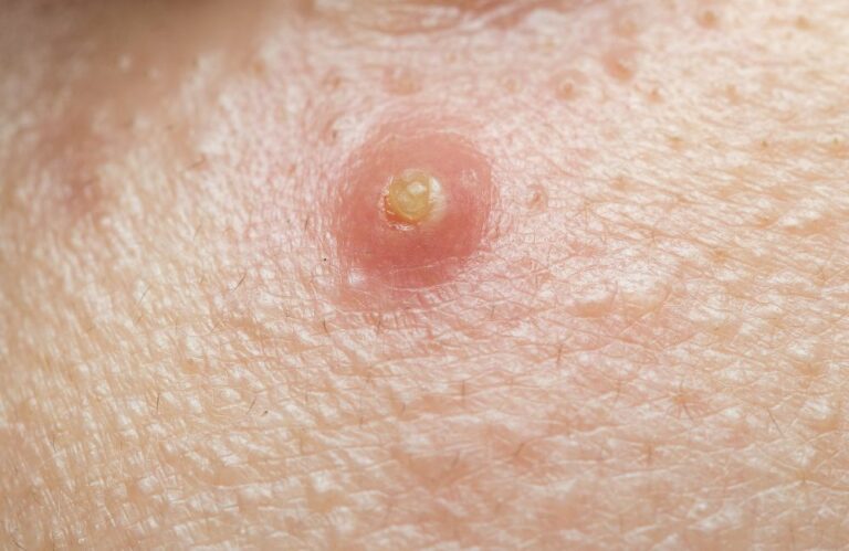 Boils: Symptoms, Causes, Prevention, and Treatment with Urgent Care in ...