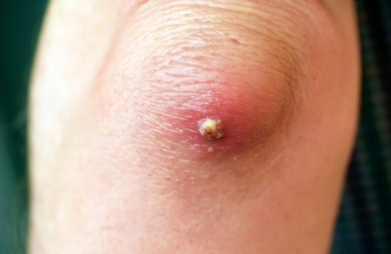 How to Care for Abscesses at Home and When to Visit Primary Care Doctor ...