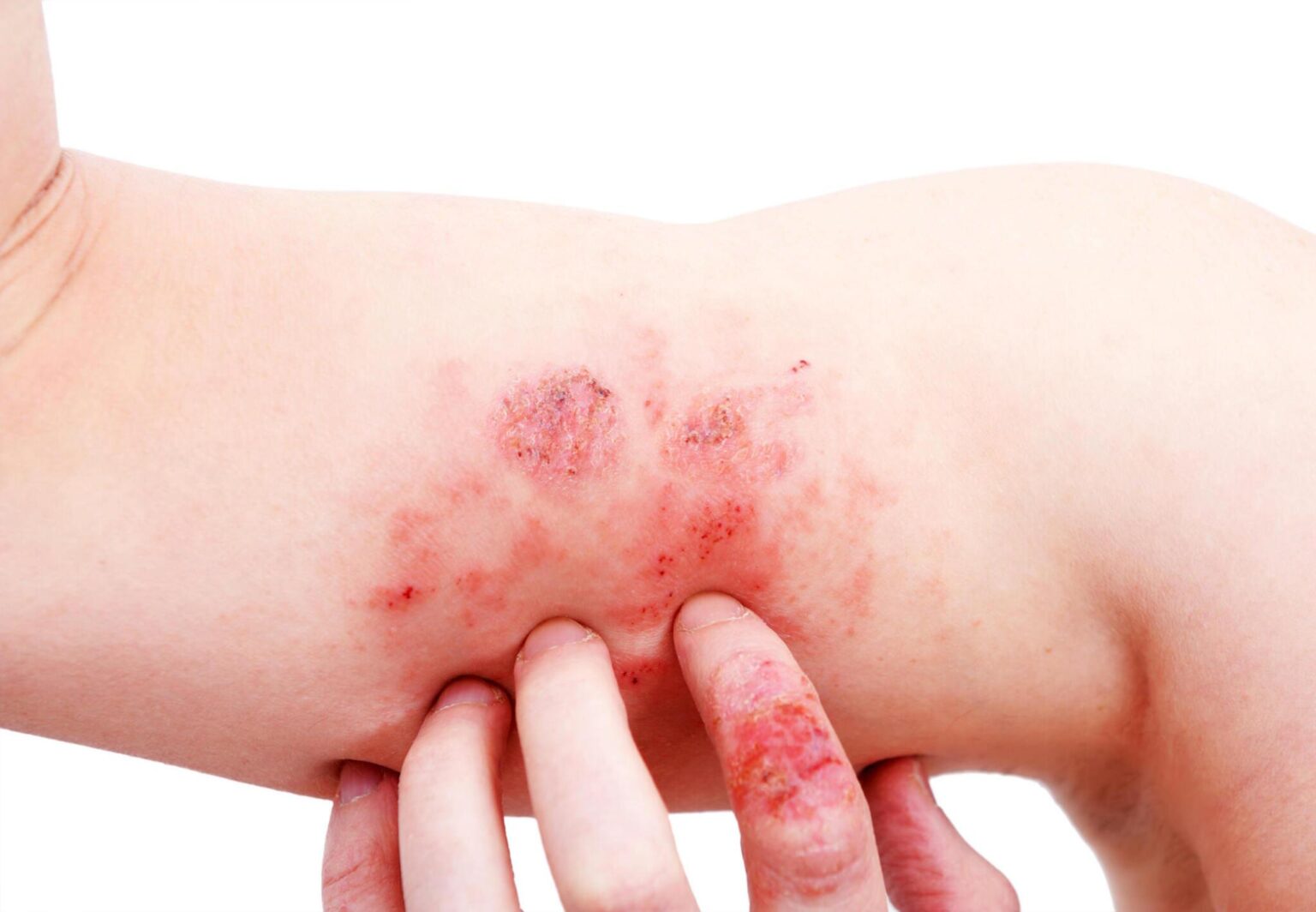 Skin Infections: Symptoms, Causes, and When to Seek Urgent Care in ...